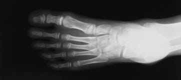 X-ray Foot AP : Show Normal Child's Foot Stock Photo - Image: 38311814