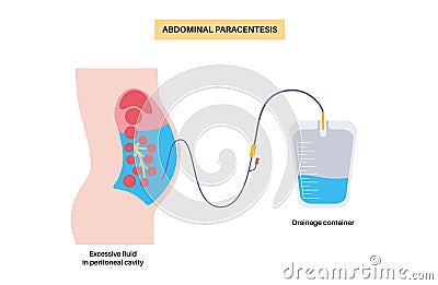 Abdominal Paracentesis Poster Cartoon Vector | CartoonDealer.com #280717123