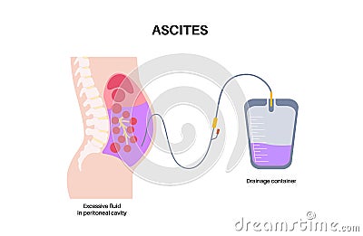 Abdominal Paracentesis Poster Cartoon Vector | CartoonDealer.com #281039655