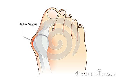 Abnormal Of Foot Shape From Deformity Joint Toe. Cartoon Vector ...
