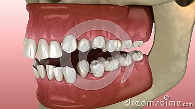 Abnormal Teeth Position, Orthodontic Concept. Medically Accurate Tooth ...