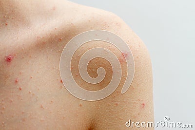 Acne Female Body With Skin In Pimples Royalty-Free Stock Photography ...