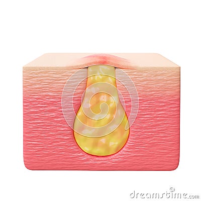 Acne Is The Inflammatory Process Of The Sebaceous Glands And ...