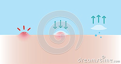 Acne Pimple Patch For Papule Vector Illustration On Blue Background ...