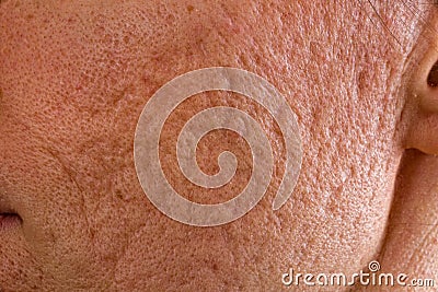 Acne Scars On Cheek Stock Photo - Image: 47292498