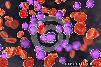 Acute Lymphoblastic Leukemia Royalty-Free Illustration | CartoonDealer ...