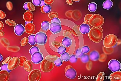 Acute Lymphoblastic Leukemia Royalty-Free Illustration | CartoonDealer ...