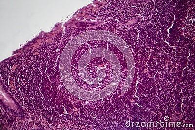 Acute Simple Appendicitis, Light Micrograph Royalty-Free Stock ...