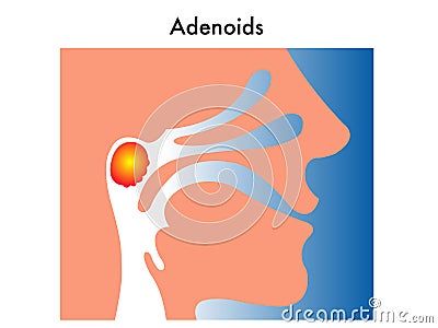 Adenoids Vector Illustration | CartoonDealer.com #18190988
