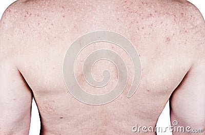 Adult Male Acne Skins Problems Blemishes, Rash Stock Photography ...