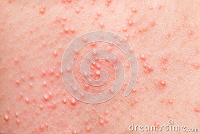 Allergic Rash Royalty Free Stock Photography - Image: 13249427