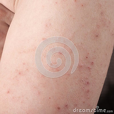 Allergic Rash Dermatitis Royalty Free Stock Photography - Image: 24973757