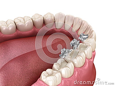 Amalgam Restoration. Medically Accurate 3D Animation Of Dental Concept ...