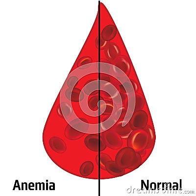 Anemia And Normal Ammount Of Red Blood Cells Cartoon Vector ...