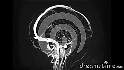 Angiography of the Brain or 3D MIP Image Showing Cerebral Artery of the ...
