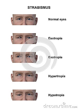 A Man With Various Strabismus Types, 3D Illustration | CartoonDealer ...