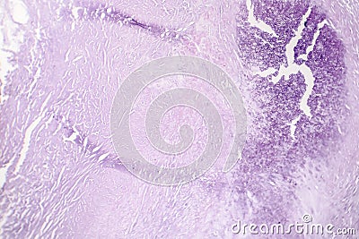 Aortic Atherosclerosis, Light Micrograph Stock Photography ...