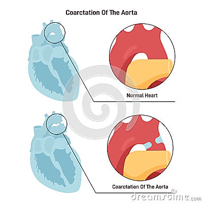 Aortic Coarctation. Birth Defect In Which A Part Of The Aorta Narrowing ...