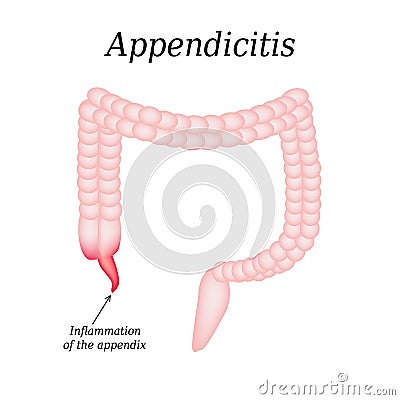 Appendicitis. Inflammation Of The Appendix. Colon. The Illustration On ...