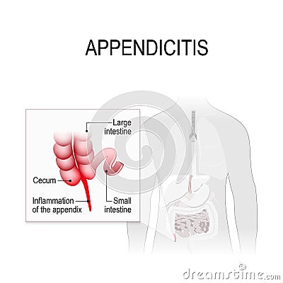 Appendicitis. Location In The Human Digestive System Stock Vector ...