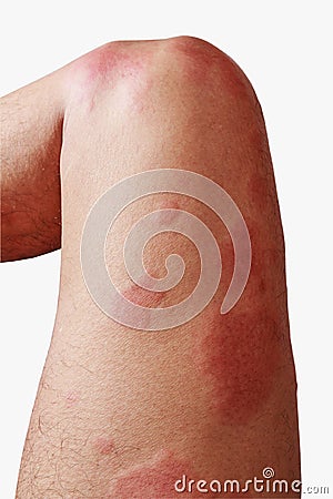Around Legs Allergy Rash And Health Problem. Stock Photo - Image: 68802516