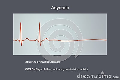 ECG In Asystole, 3D Illustration Royalty-Free Cartoon | CartoonDealer ...