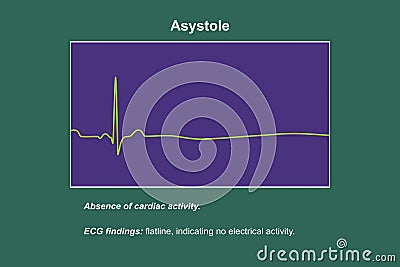 ECG In Asystole, 3D Illustration Royalty-Free Cartoon | CartoonDealer ...