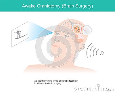 Awake Craniotomy. A Patient Receiving Visual And Audio Test Brain ...