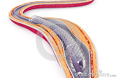 Balloon Expandable Stent Royalty-Free Illustration | CartoonDealer.com ...