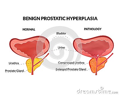 Benign Prostatic Hyperplasia Vector Illustration | CartoonDealer.com ...