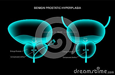 BPH Info Concept Vector Illustration | CartoonDealer.com #203408268