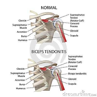 Biceps Tendonitis, Shoulder Joint, Realistic Vector Illustration ...