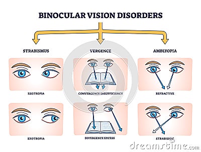 Binocular Vision Disorders With All Eye Defect Examples Outline Diagram ...