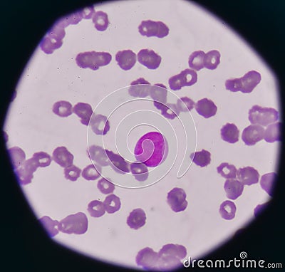 Blast Cell On Blood Smear. Stock Image | CartoonDealer.com #96652969