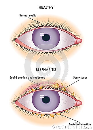Blefarite Foto de Stock - Imagem: 54435776