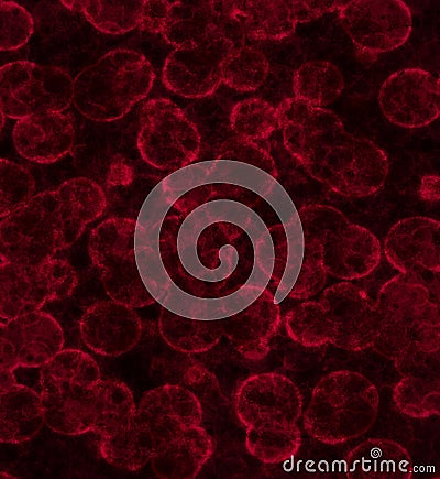 Blood With Infection Close-up. Infected Cells Under A Microscope ...