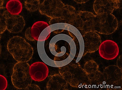 Blood With Infection Close-up. Infected Cells Under A Microscope ...
