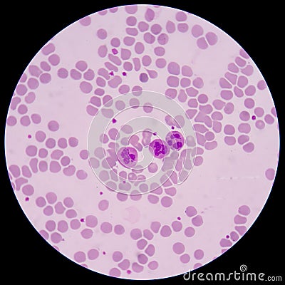 Blood Smear Form Sepsis. Stock Photo - Image: 63194297