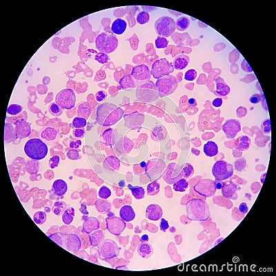 Blood Smear Showing Under Microscope WBC is Atpical Lymphocyte. Stock ...