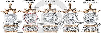 BOARD Types Of Lumbar Disc Herniation Stock Photography | CartoonDealer ...