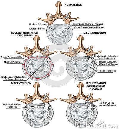 BOARD Types And Stages Of Lumbar Disc Herniation Royalty-Free Stock ...