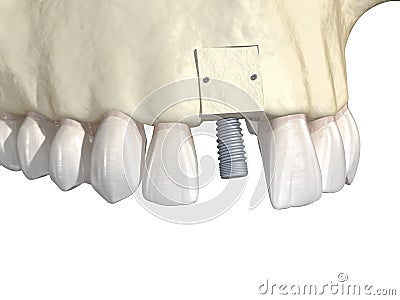 Bone Grafting- Augmentation Using Block Of Bone, Tooth Implantation ...