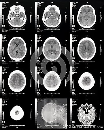 Brain CT With Scout Stock Image | CartoonDealer.com #6898519