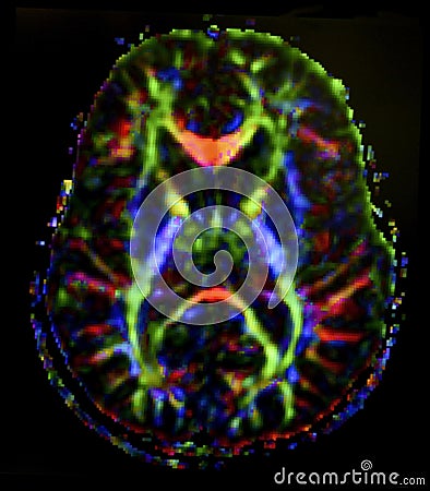 Brain Diffusion Tensor Imaging Stock Image - Image: 32386771
