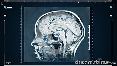 Brain Scan Visualization Animation. Special Medical Equipment for Tumor ...