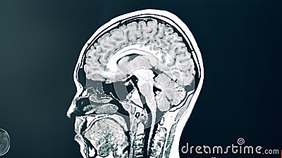 Brain Scanning during an MRI Procedure Stock Video - Video of ...