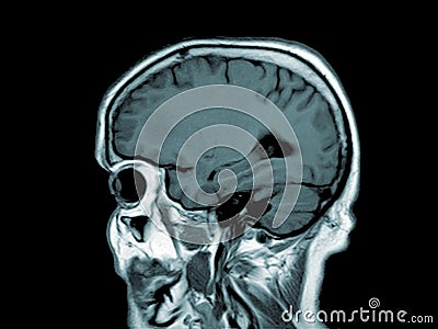 Brain Tumor Film CT-scan of Brain : Show Part of Brain with Tumor Stock ...