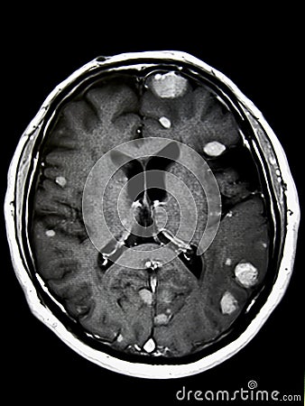 Brain Tumors, MRI Stock Photo - Image: 54630163