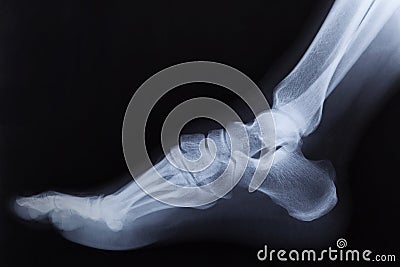 Broken Right Foot Ankle Xray. Stock Photo - Image: 57723519