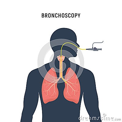 Bronchoscopy Respiratory System Emphysema Endoscopy Human Lung ...